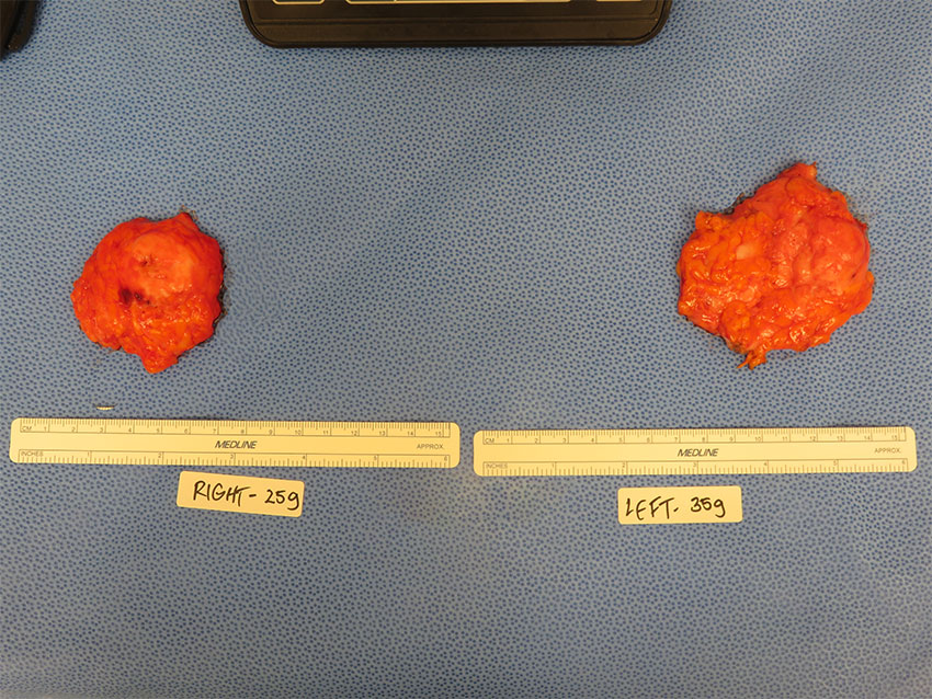 Gynecomastia Surgery For Bodybuilders - Top Gynecomastia Surgeon Dr ...